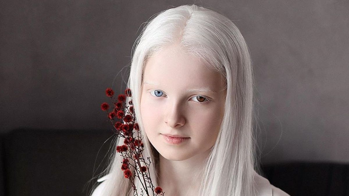 Csodáld meg az albínó lány egyedülálló, szokatlan szépségét - Galéria ...