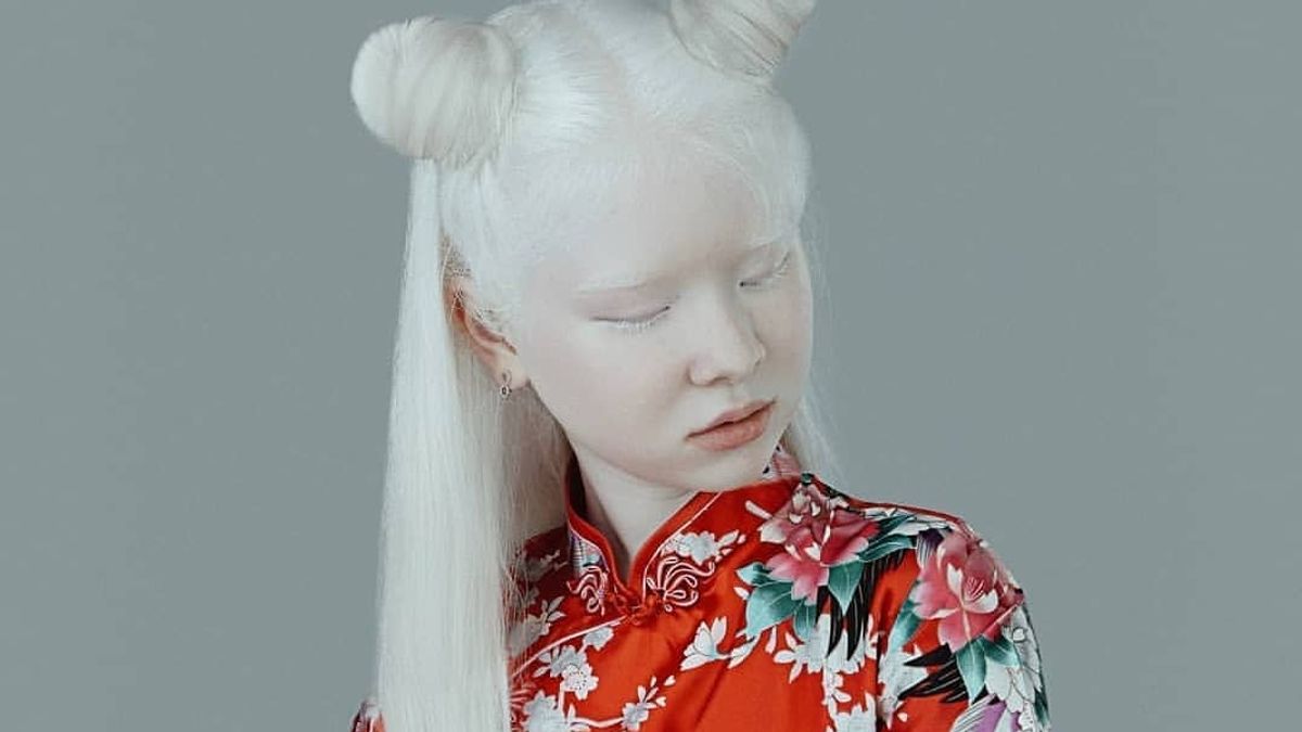 Egy albínó modell, akinek testvére is pigment hiánnyal született - Life